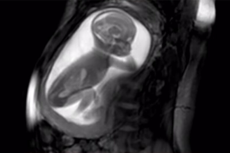 The incredible MRI scan showing a baby swallowing in utero