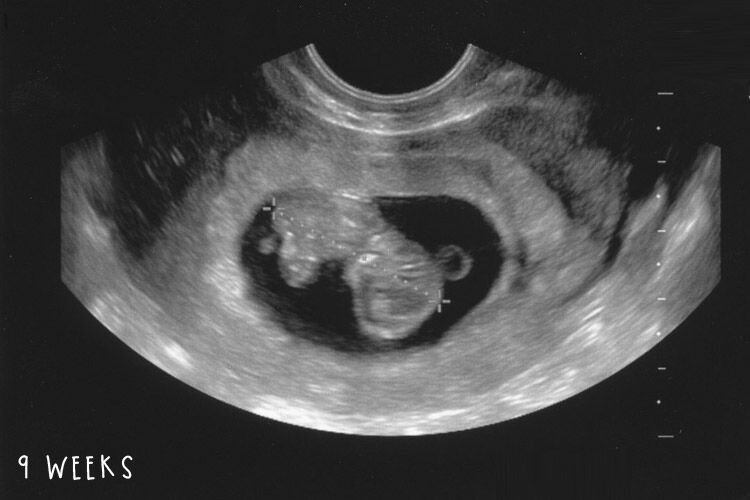 What to Expect During First Trimester Ultrasounds