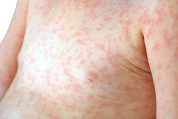 Baby and woman diagnosed with measles in NSW