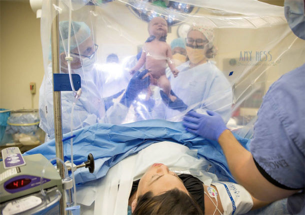 Clear drape c-sections allow mums to watch baby being born