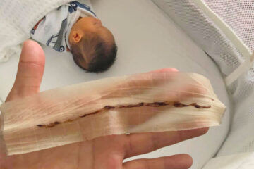 Birth Story: My C-Section Scar Reminds Me of My Strength