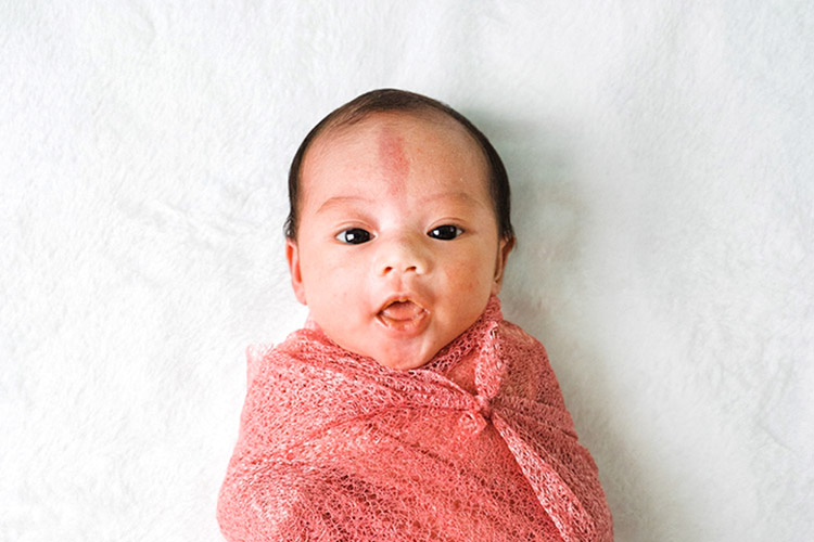 Stork Bite: what are they and when do they fade? | Mum's Grapevine