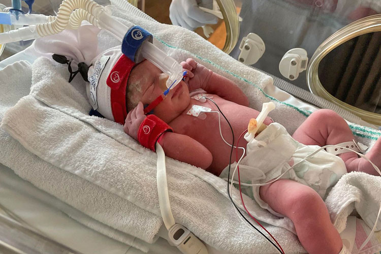 With placental mesenchymal dysplasia, Grace beats the odds